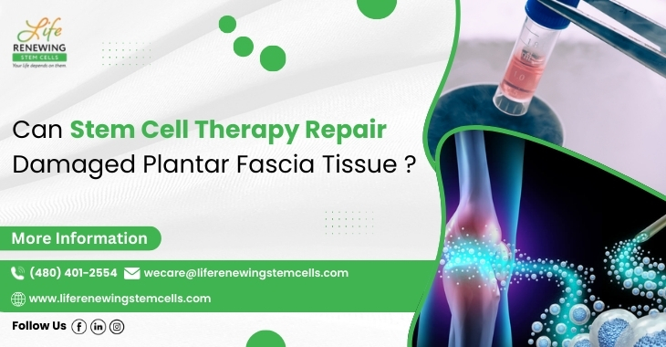 Can Stem Cell Therapy Repair Damaged Plantar Fascia Tissue?- Life ...